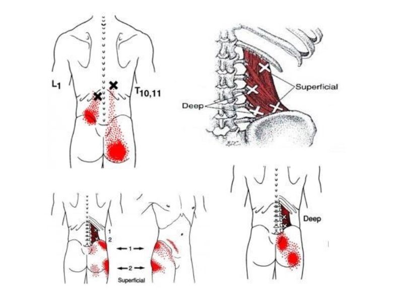 Low Back Trigger Points – Pain Relief Techniques